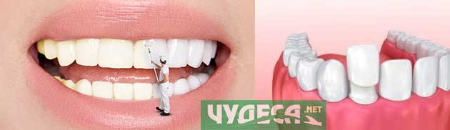 Видове фасети и кои да изберем? | Статия от стоматолог - Чудеса.net